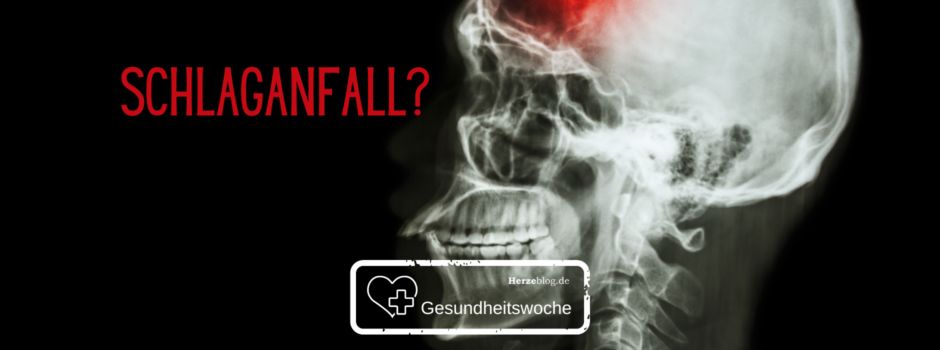 Jeder Schlaganfall ist ein Notfall. Erkennen und Verstehen. | Aktuelle ...